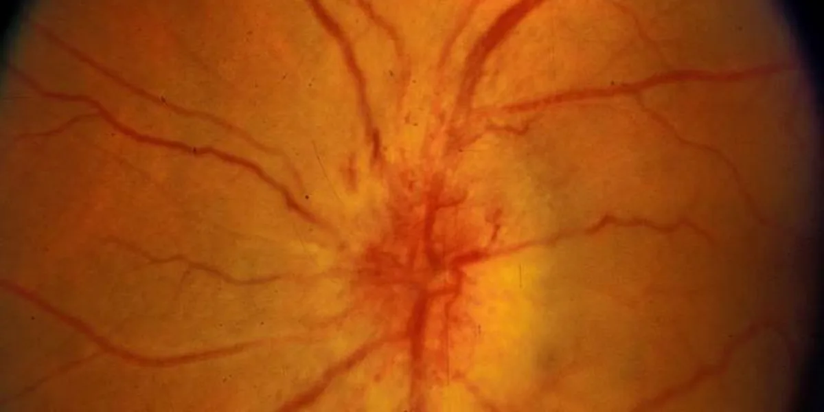 An International Treatment Trial for Patients with NAION